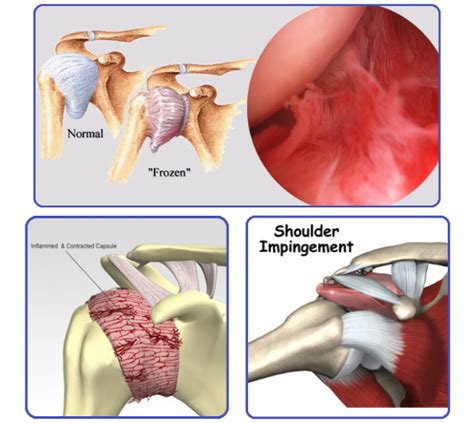 Frozen Shoulder