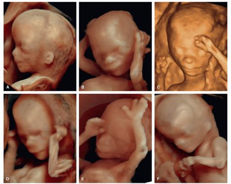 The Fetal Face And Neck Radiology Key