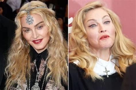 Madonna Plastic Surgery Before After Telegraph