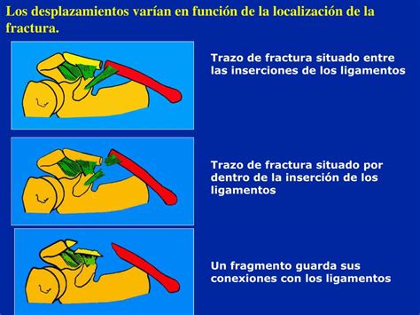 PPT Fracturas de la Clavícula PowerPoint Presentation free download