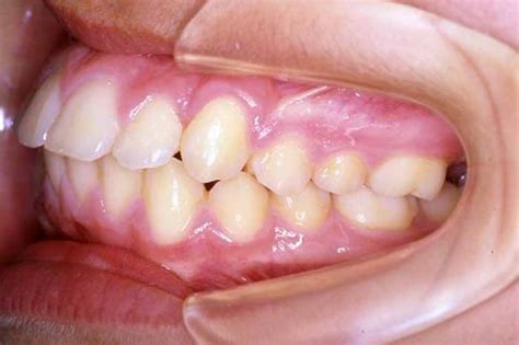 Biprotrusión Olga GLOBALORTHODONTICS