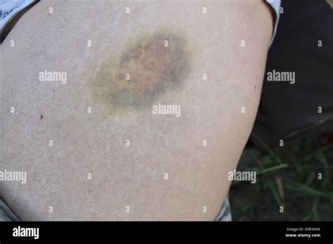 Bruise On The Leg A Large Round Bruise Of Dark Blue Color On The Leg