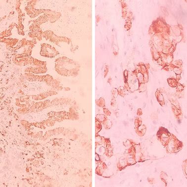 Photomicrograph Showing Tumor Cells Diffuse Positivity For CK 7 By IHC