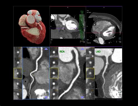 Ct Angiography Ascent Cardiology Group