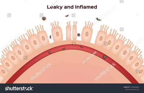 Leaky Blood Vessels Over Royalty Free Licensable Stock Vectors