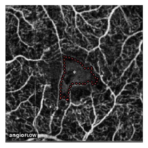 Quantifying Foveal Avascular Zone FAZ Area Morphology On Fluorescein