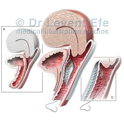 Anterior Vaginal Wall Repair Dr Efes Medical Art Store Medical
