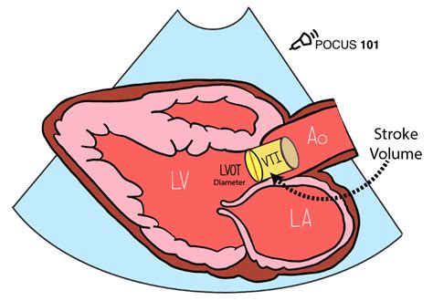 Measuring Cardiac Output With Echocardiography Made Easy Pocus