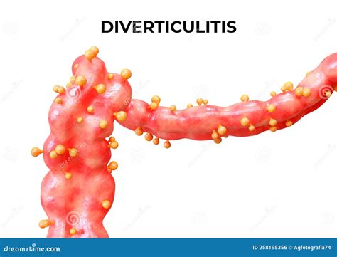 Diverticulosis And Diverticulitis Cartoon Vector Cartoondealer