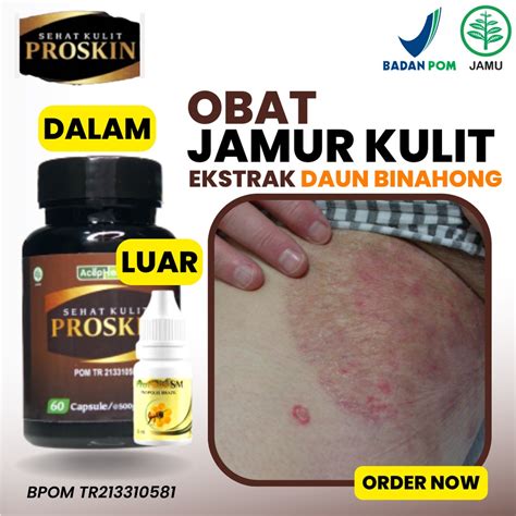 Jual Obat Jamur Kulit Selangkangan Panu Kadas Kurap Eksim Kering Basah