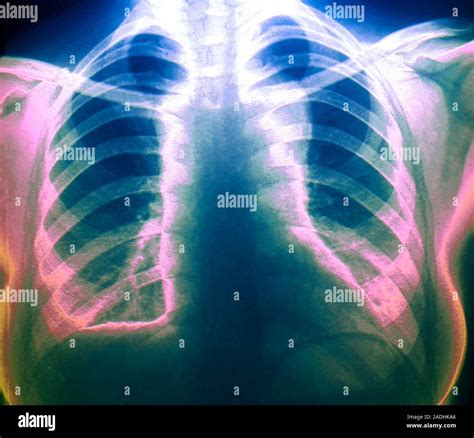 La Neurofibromatose Frontal Couleur Radiographie Pulmonaire D Un