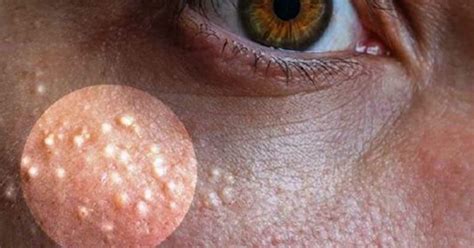 Supprimez le Milium acné miliaire du Visage Grâce à Des Remèdes Naturels