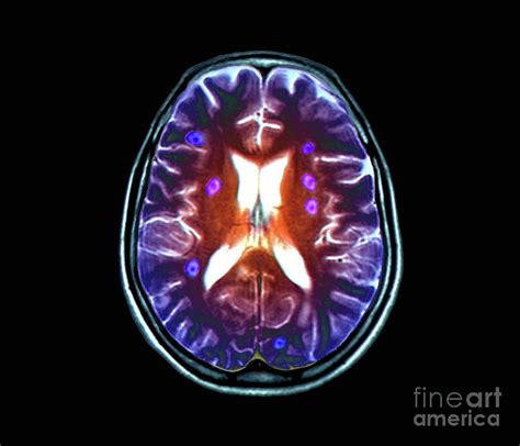 Secondary Brain Cancer Photograph By Zephyr Science Photo Library
