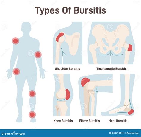 Bursitis Inflammation Concept Cartoon Vector Cartoondealer The Best