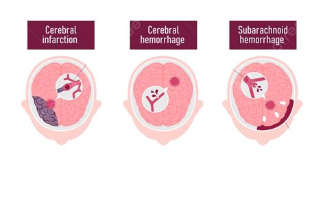 Tipos De Accidente Cerebrovascular Humano Ilustraci N Vectorial