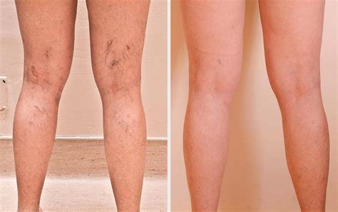 Varicose Veins Relief Cream Medilisk