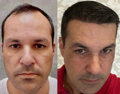 Antes e Depois do Tratamento de Calvície Clínica Rejuvenesce
