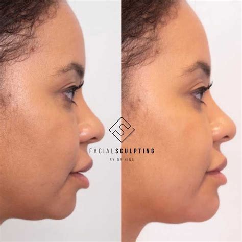 Jawline Sculpting Before And After The Best Treatments For A Defined