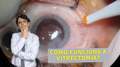 Como funciona a Vitrectomia Dr João Paulo Lomelino YouTube