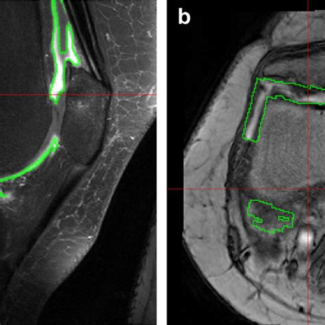 A Sagittal Post Contrast T1 Weighted Fat Suppressed Turbo Spin Echo