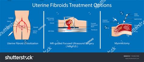 Uterine Fibroid Embolization Images Stock Photos Vectors
