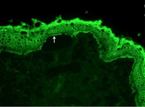 Indirect Immuno Fluorescence Of M Nacl Split Foreskin Showing Igg