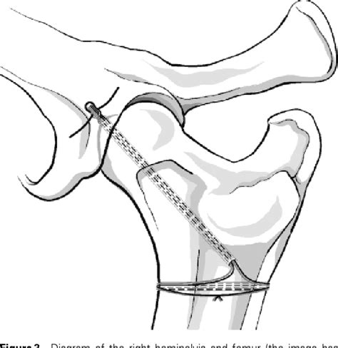 Figure 3 From Toggle Pin Technique For Management Of Coxofemoral
