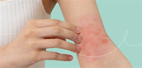 Dermatite Atopica Tra Cause Sintomi E Serena Convivenza Ontherapy