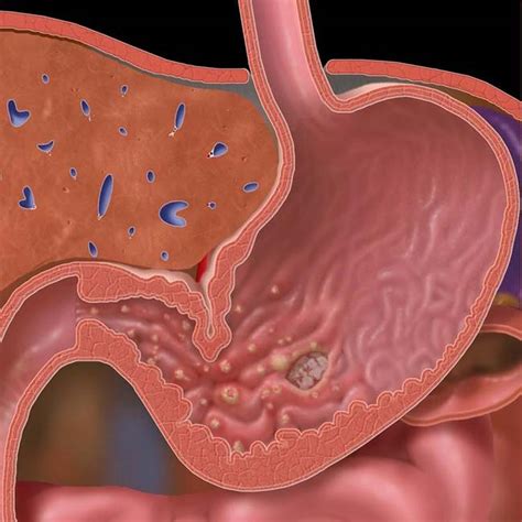 Gastric Mucosal Redness Erosion And Small Ulcers In The Antrum As Hot