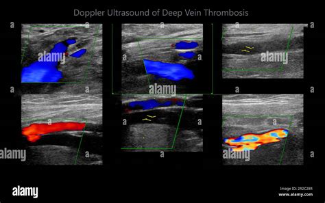 Détermination par échographie Doppler couleur chez les patients