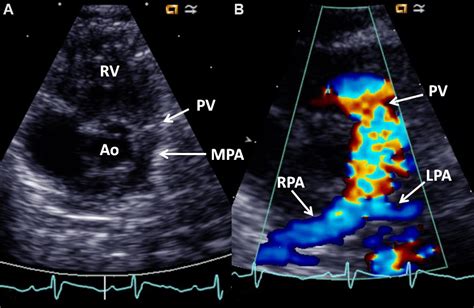 Echocardiography An Overview Part Iii