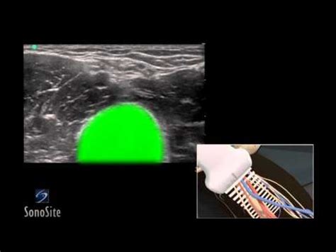 How To Ultrasound Guided Peripheral Inserted Venous Catheter 3D Video