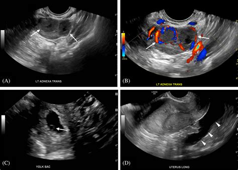 Corpus Luteum Ultrasound