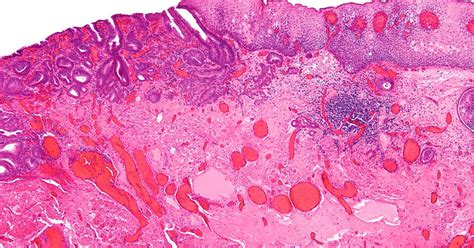Actualités Scientifiques Médicales thelancetoncology