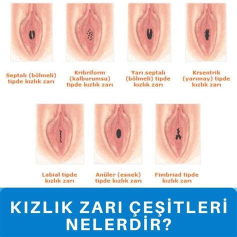 Kızlık Zarı Kanı Kanaması Bozulması Zedelenmesi 2024