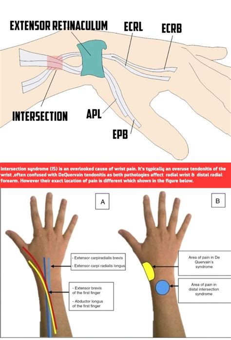 𝐃𝐫 𝐎𝐌𝐈𝐃 𝐁𝐀𝐍𝐃𝐀𝐑𝐂𝐇𝐈 𝐌 𝐃 on Twitter INTERSECTION SYNDROME Proximal IS