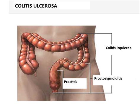Colitis Ulcerosa M Dico Especialista Aparato Digestivo Dr Onofre
