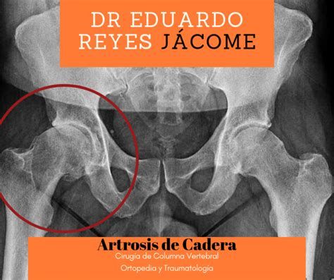 Artrosis De Cadera Coxartrosis Cirugia De Columna En Matamoros