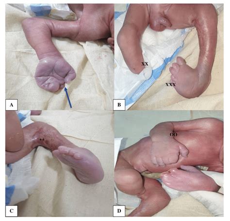 Amniotic Band Syndrome