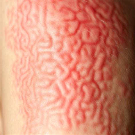 Alergia pokarmowa u dorosłych objawy skórne Alergologia bez krawata