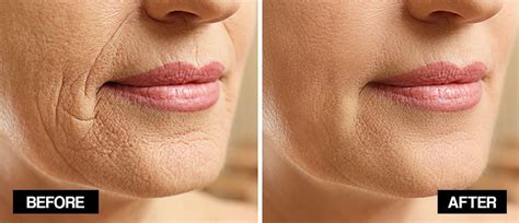4 Ways To Get Rid Of Wrinkles Around Mouth Naturally Artofit