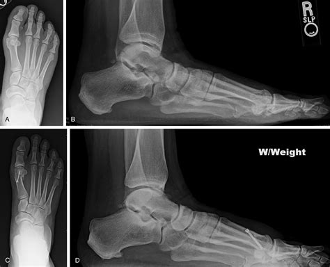 Comparison Of Chevron And Distal Oblique Osteotomy For Bunion