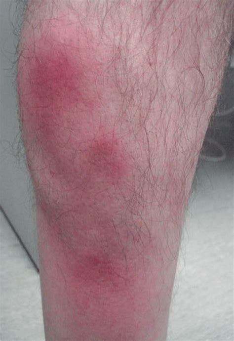 Tromboflebitis Superficial Migratoria Revisi N Cl Nica E Histol Gica