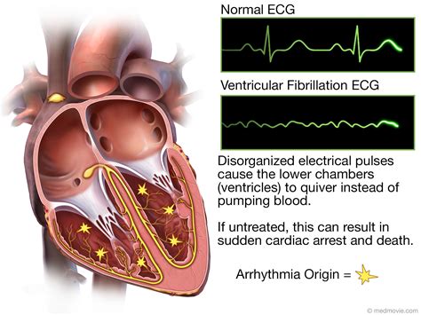 Medmovie Ventricular Fibrillation