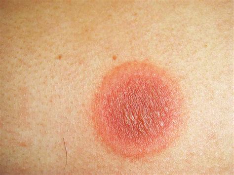 Brown Hospital Medicine On Twitter A 35 Year Old Man Presented With A