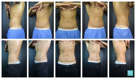 CoolSculpting For Men Upper Lower Abdomen Before After Results Fat