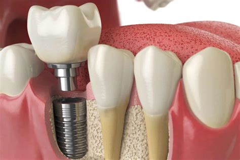 Pr Teses Sobre Implantes Dent Rios O Que S O E Que Tipos Existem