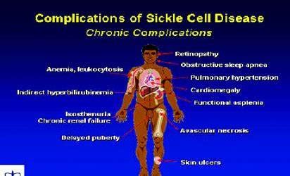 Np Sickle Cell Anemia Flashcards Quizlet