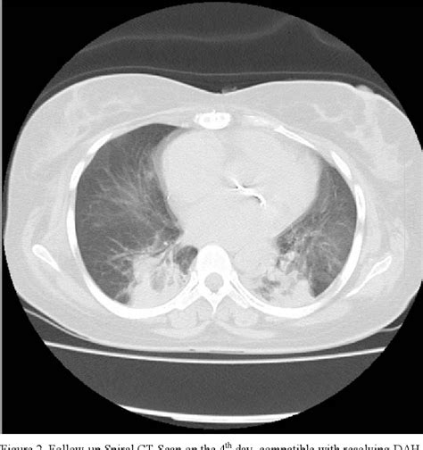 Figure 2 From A Rare Case Of Diffuse Alveolar Hemorrhage DAH Due To