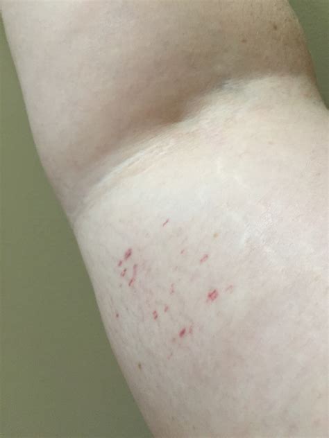 Petechiae Arms